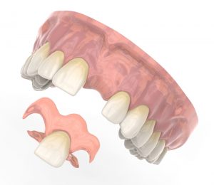 Pont papillon | Portail Dentaire | Trouvez votre dentiste