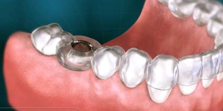 Chirurgie implantaire avec guide numérique | Portail Dentaire | Trouvez ...